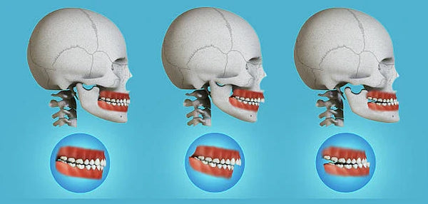 Fix Bite Problems With Retainers | NewSmile™ Guide - NewSmile UK