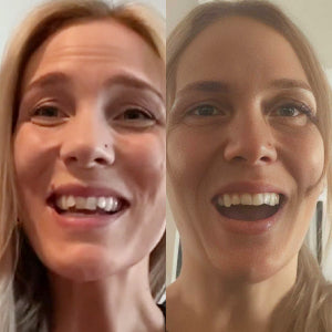 NewSmile™ Clear Aligners To Straighten Teeth At Home