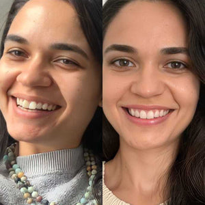 Retainers - Keep Your Teeth Straight After Clear Aligners | NewSmile ...